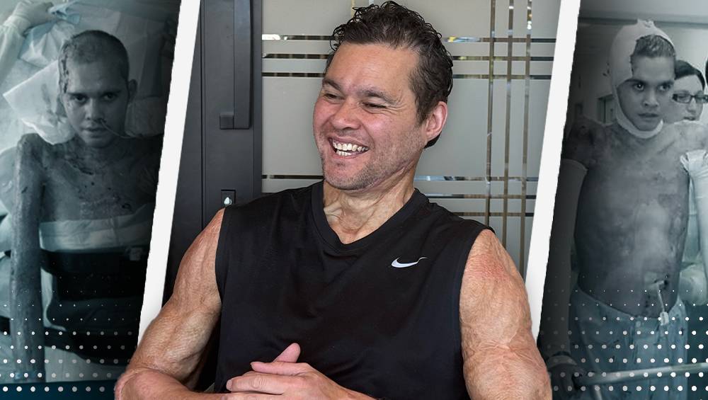 Struck twice by 110,000 volts, Troy Hall has a powerful message